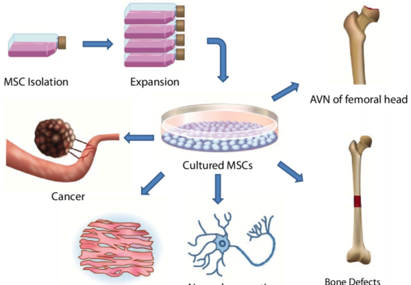 AVASCULAR NECROSIS - Cell Tissue Technology