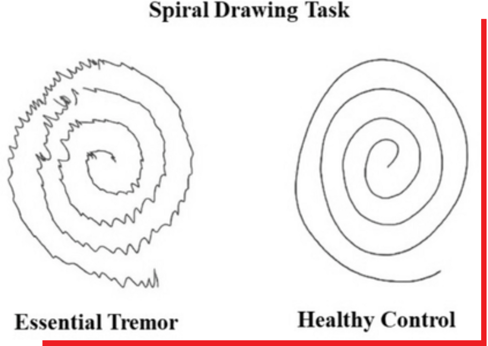 ESSENTIAL TREMOR - Cell Tissue Technology